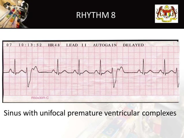 Rhythm recognition | PPTX | Heart and Cardiovascular Diseases ...