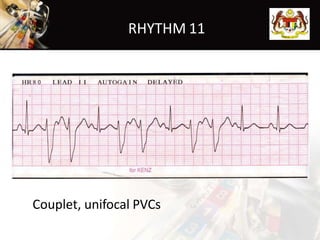Rhythm recognition | PPTX | Heart and Cardiovascular Diseases ...