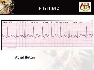 Rhythm recognition | PPTX | Heart and Cardiovascular Diseases ...