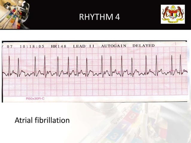 Rhythm recognition | PPTX | Heart and Cardiovascular Diseases ...