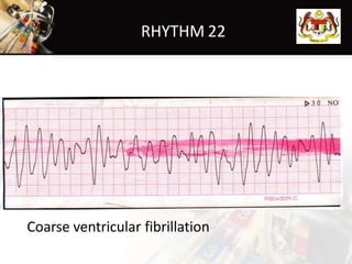 Coarse Ventricular Fibrillation