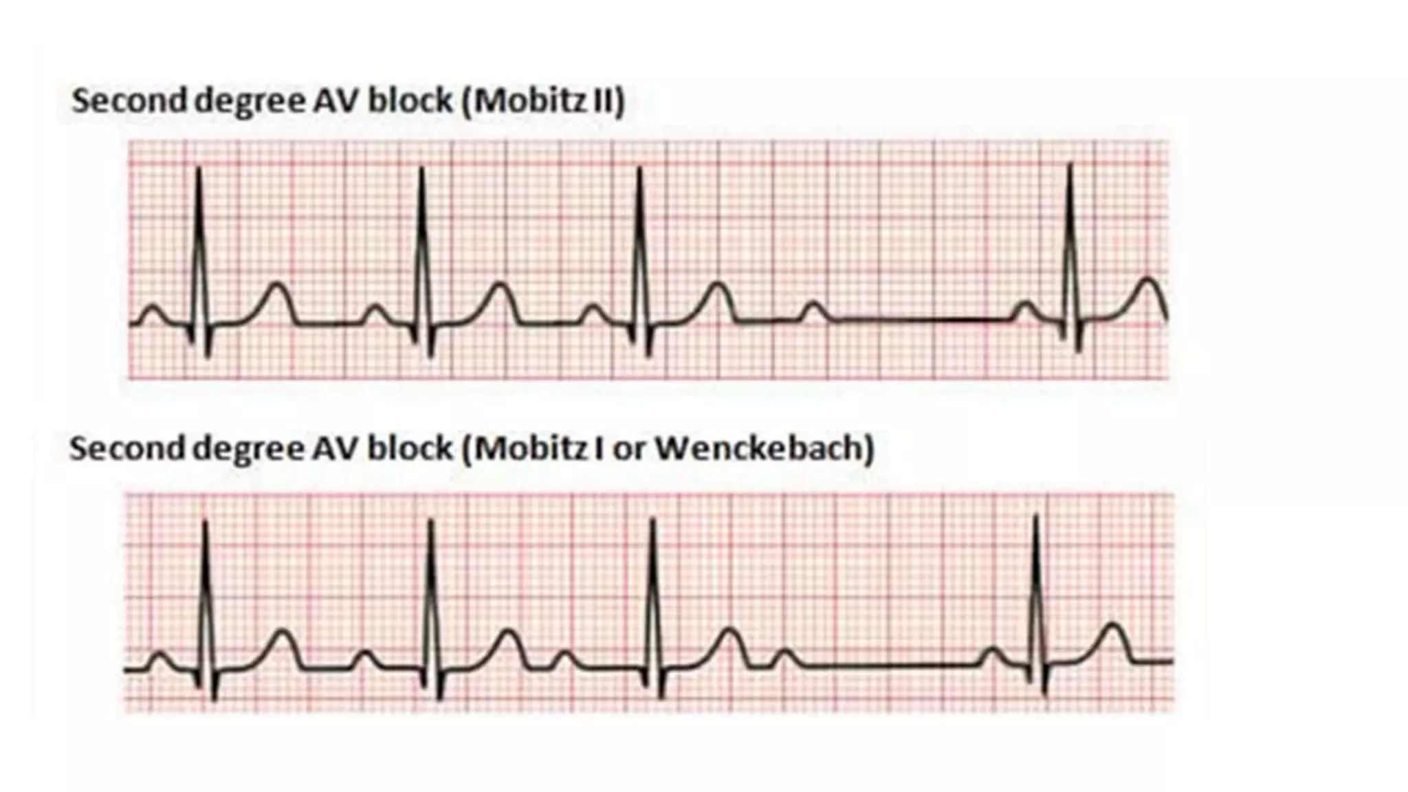 basic ECG rhythms & rhythms on different conditions | PPT