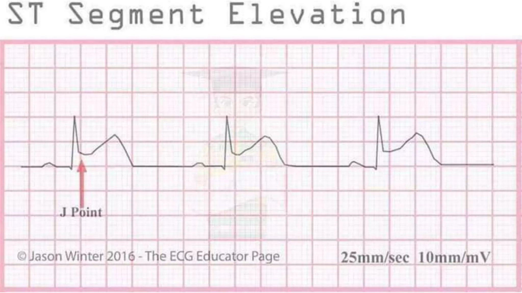 basic ECG rhythms & rhythms on different conditions | PPTX