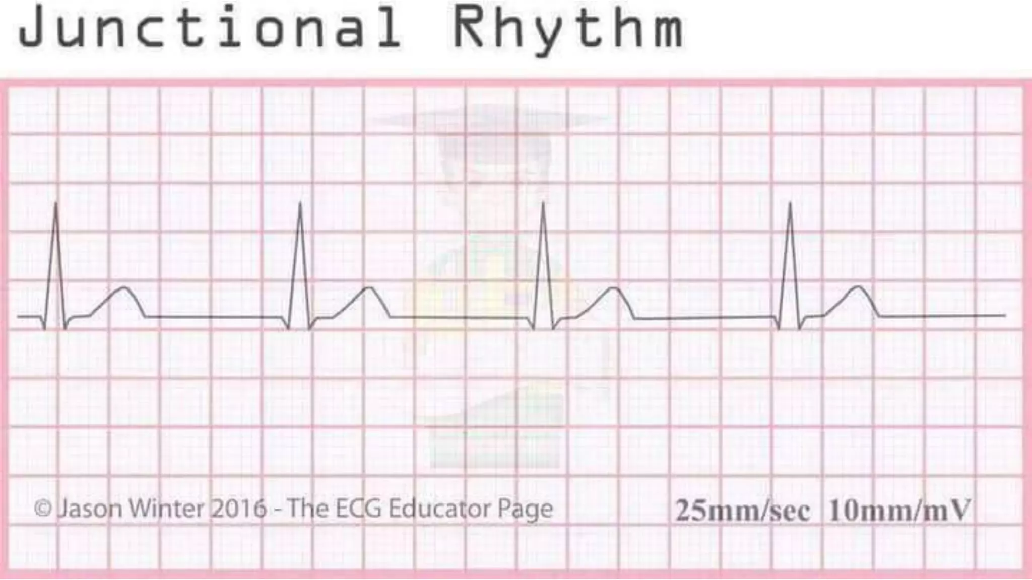 basic ECG rhythms & rhythms on different conditions | PPT