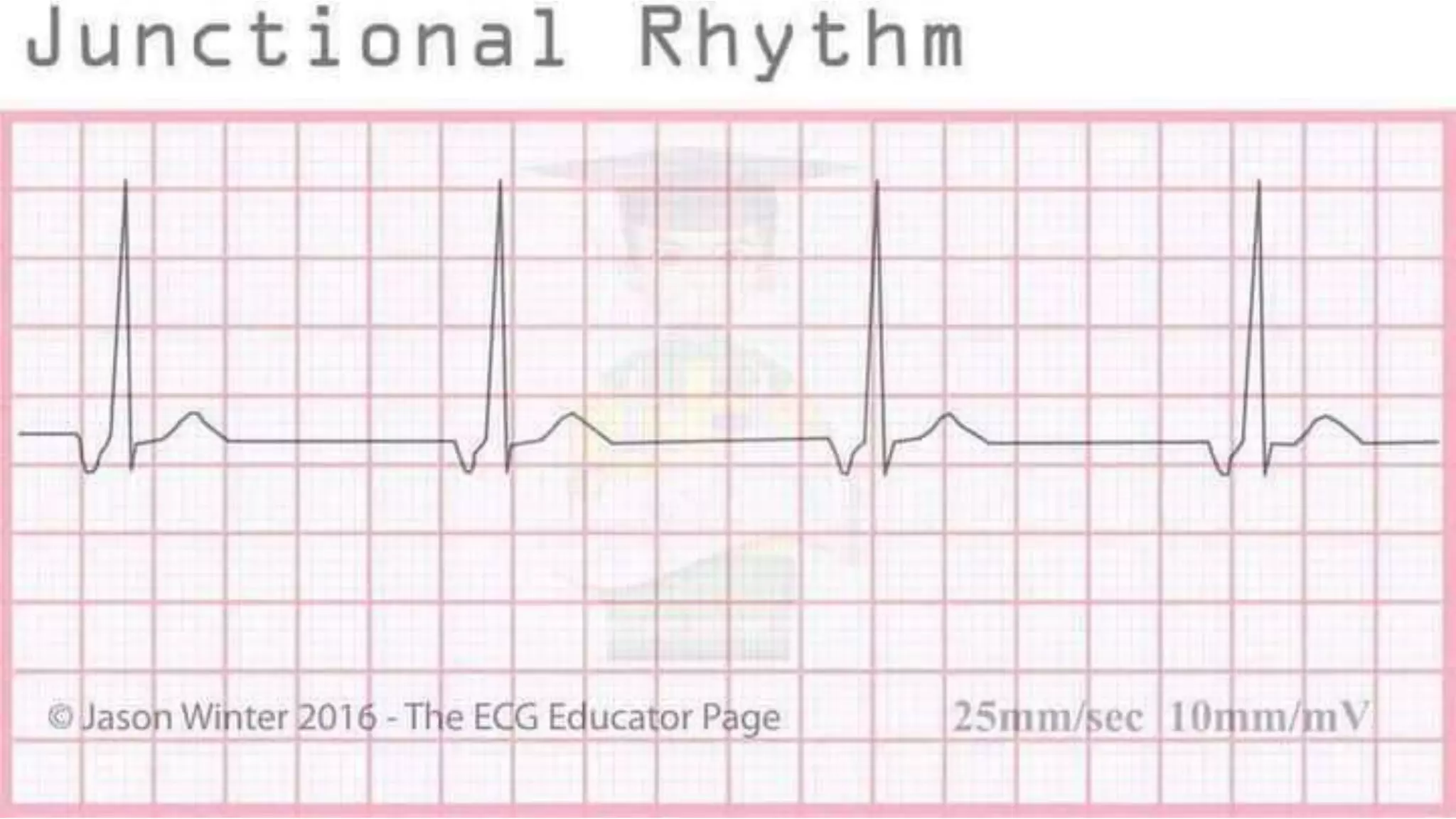 basic ECG rhythms & rhythms on different conditions | PPTX | Heart and ...