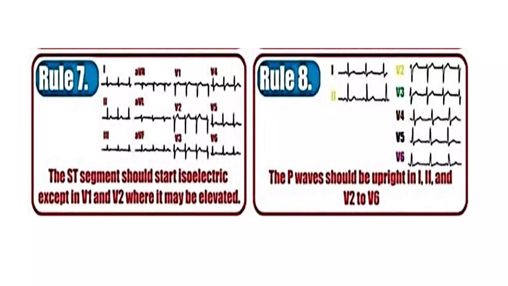 basic ECG rhythms & rhythms on different conditions | PPTX