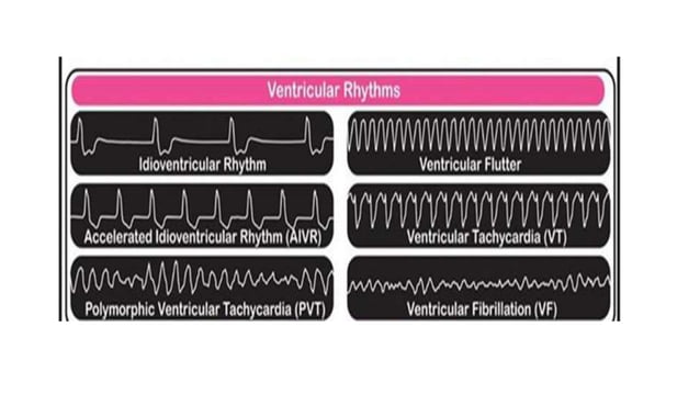 basic ECG rhythms & rhythms on different conditions | PPT