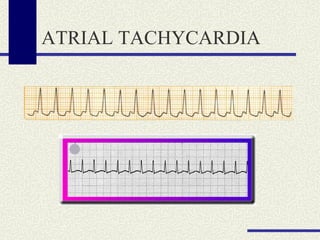 Supraventricular Tachycardia Rhythm Strip