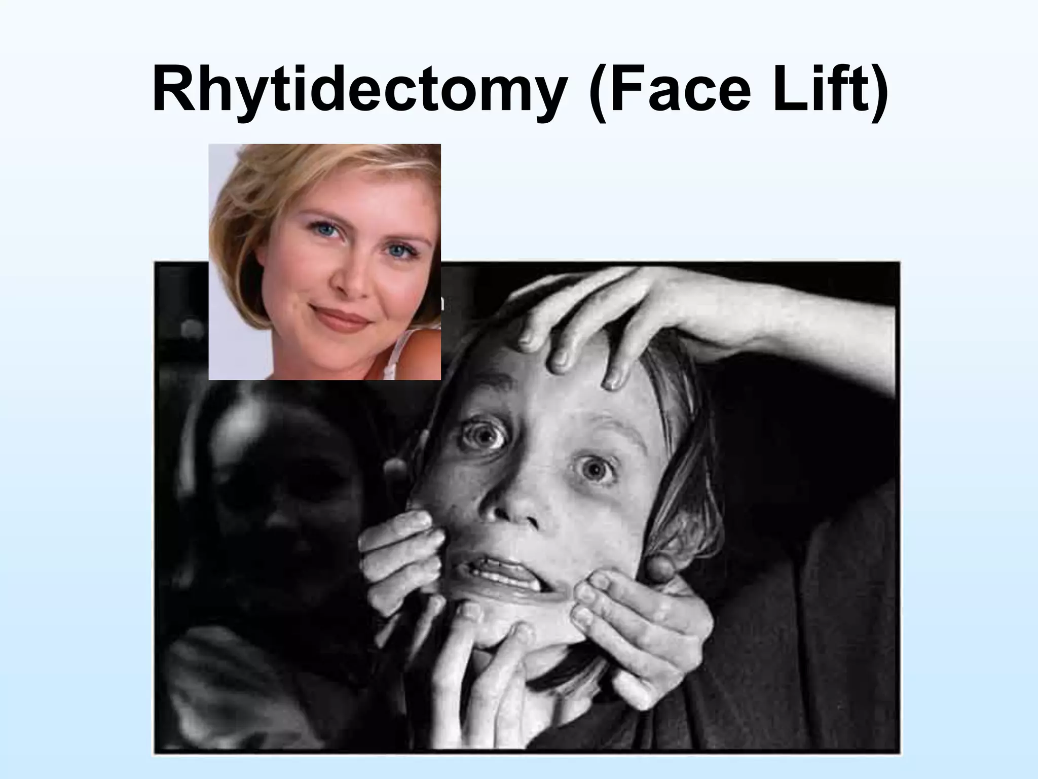 Rhytidectomy (Face Lift) | PPT