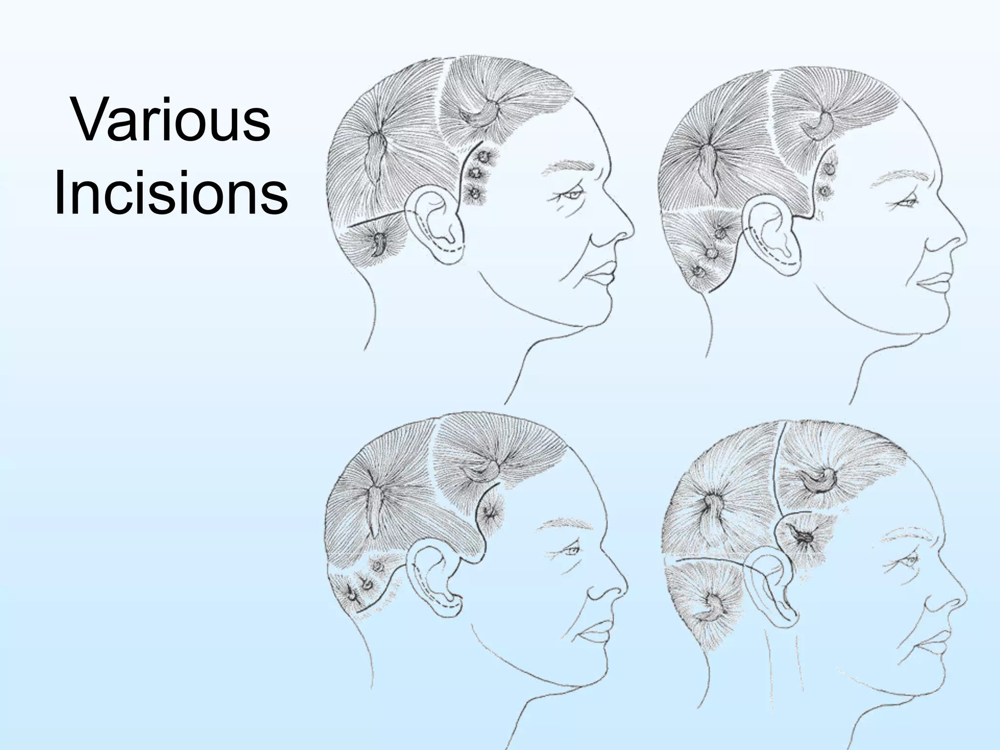 Rhytidectomy (Face Lift) | PPT