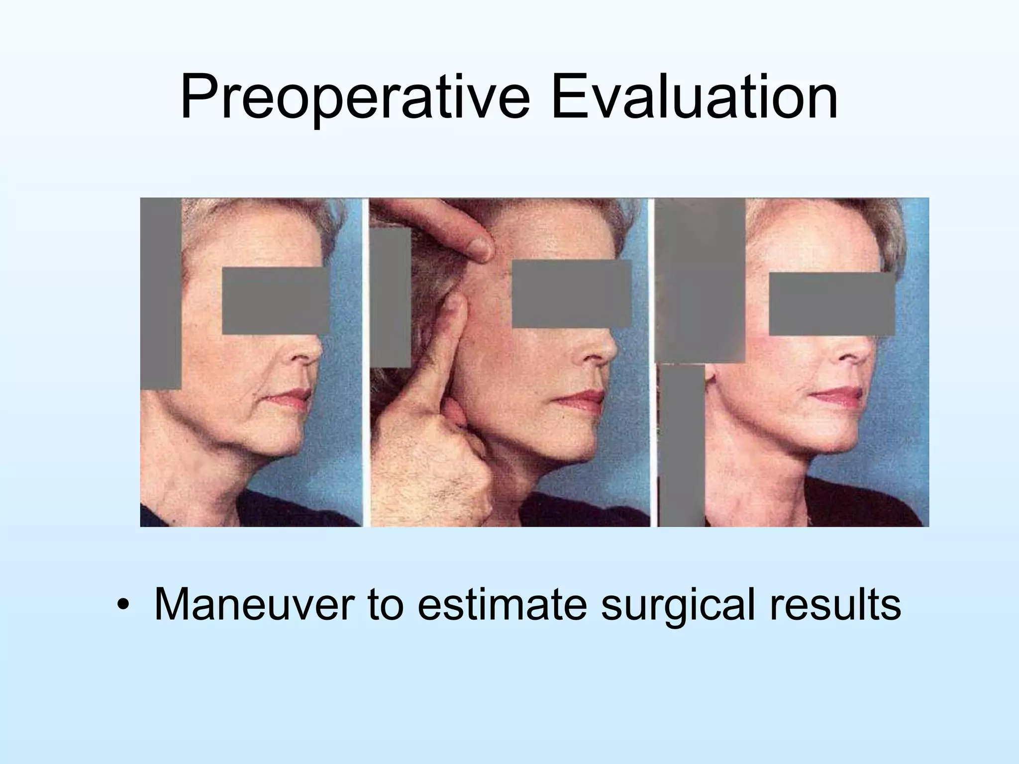 Rhytidectomy (Face Lift) | PPT