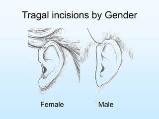 Rhytidectomy (Face Lift) | PPT