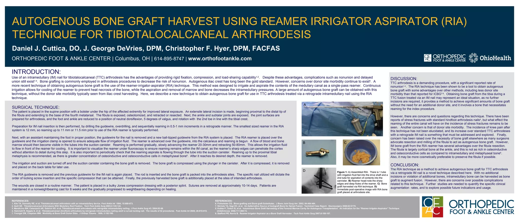 Autogenous Bone Graft Harvest Using Reamer-Irrigator-Aspirator (RIA) Technique for ...