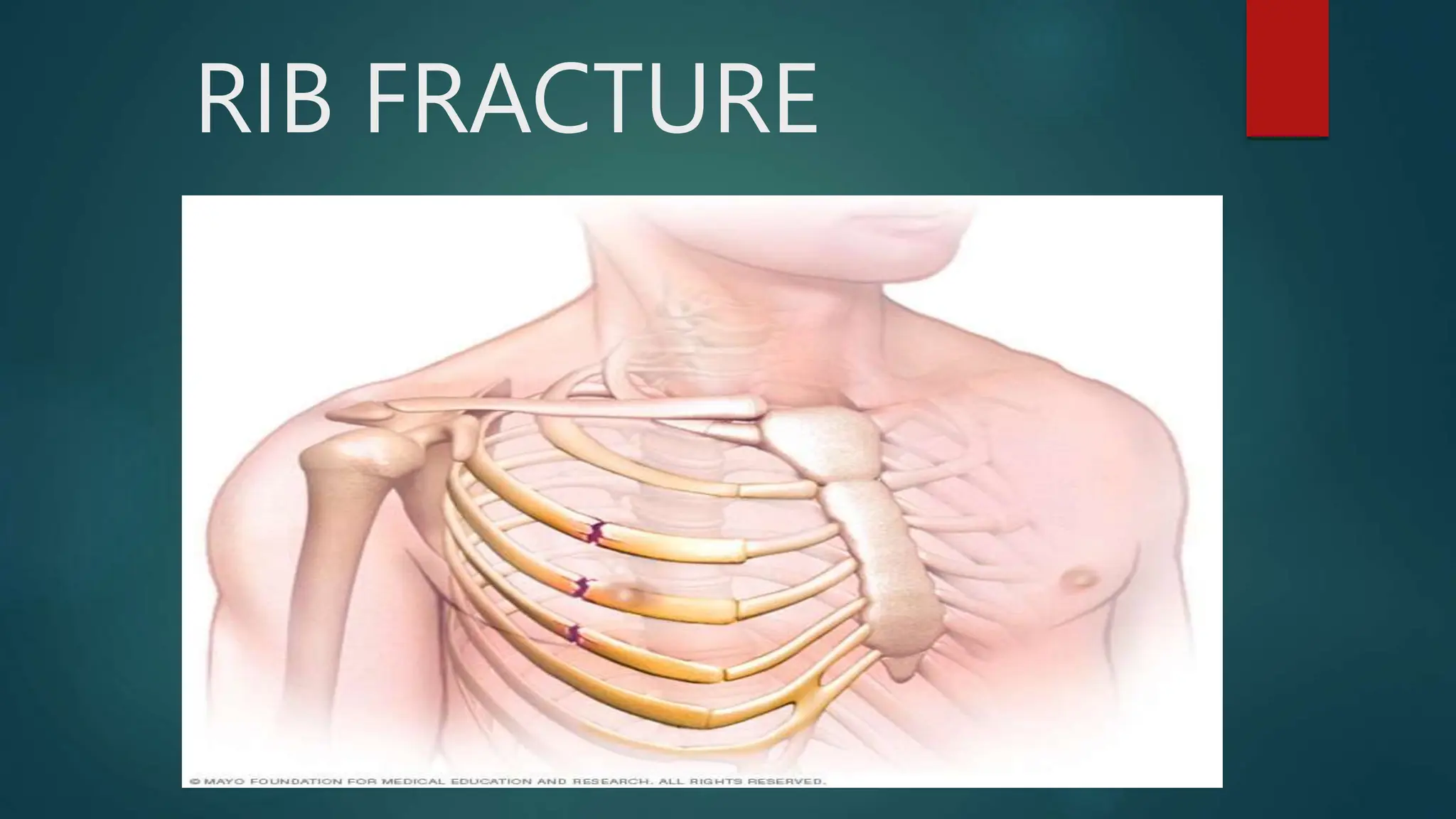 Rib Fractures, Flail Chest & Stove In Chest | PPTX