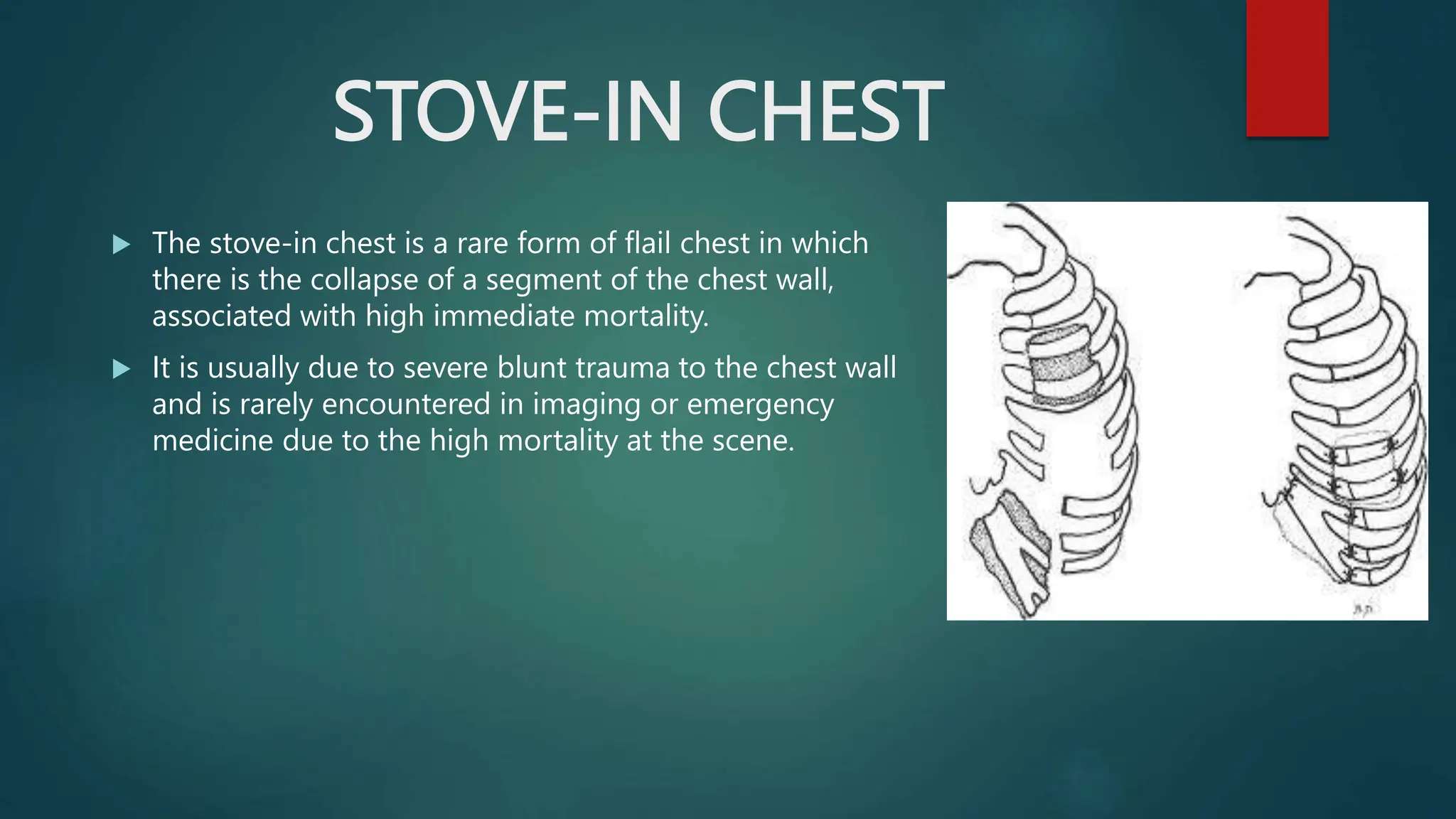 Rib Fractures, Flail Chest & Stove In Chest | PPTX