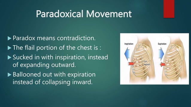 Rib Fractures, Flail Chest & Stove In Chest | PPTX