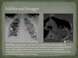 Rib fracture | PPTX