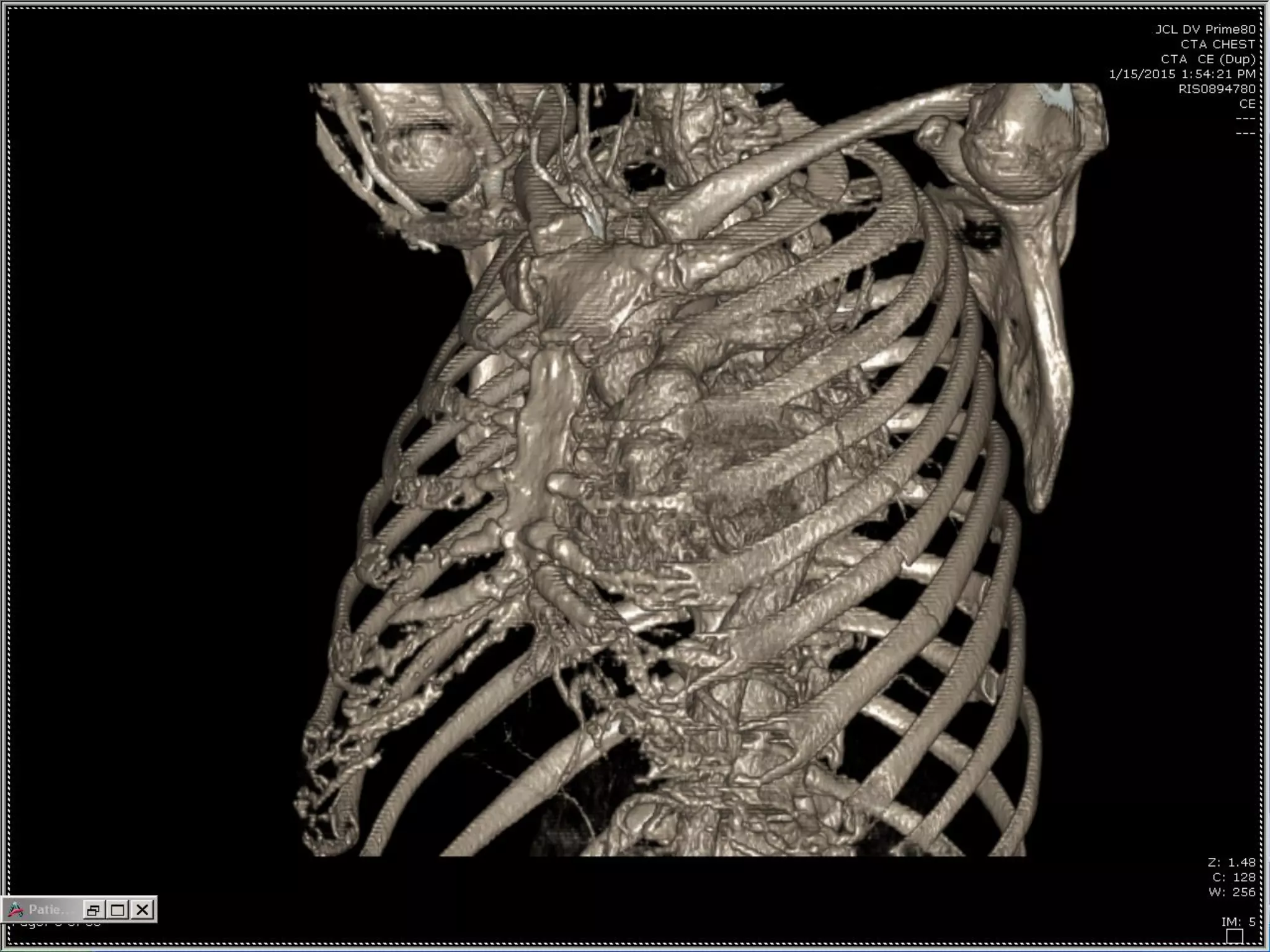 Rib Fractures in the Elderly (Dr. Francis Ali-Osman) | PDF