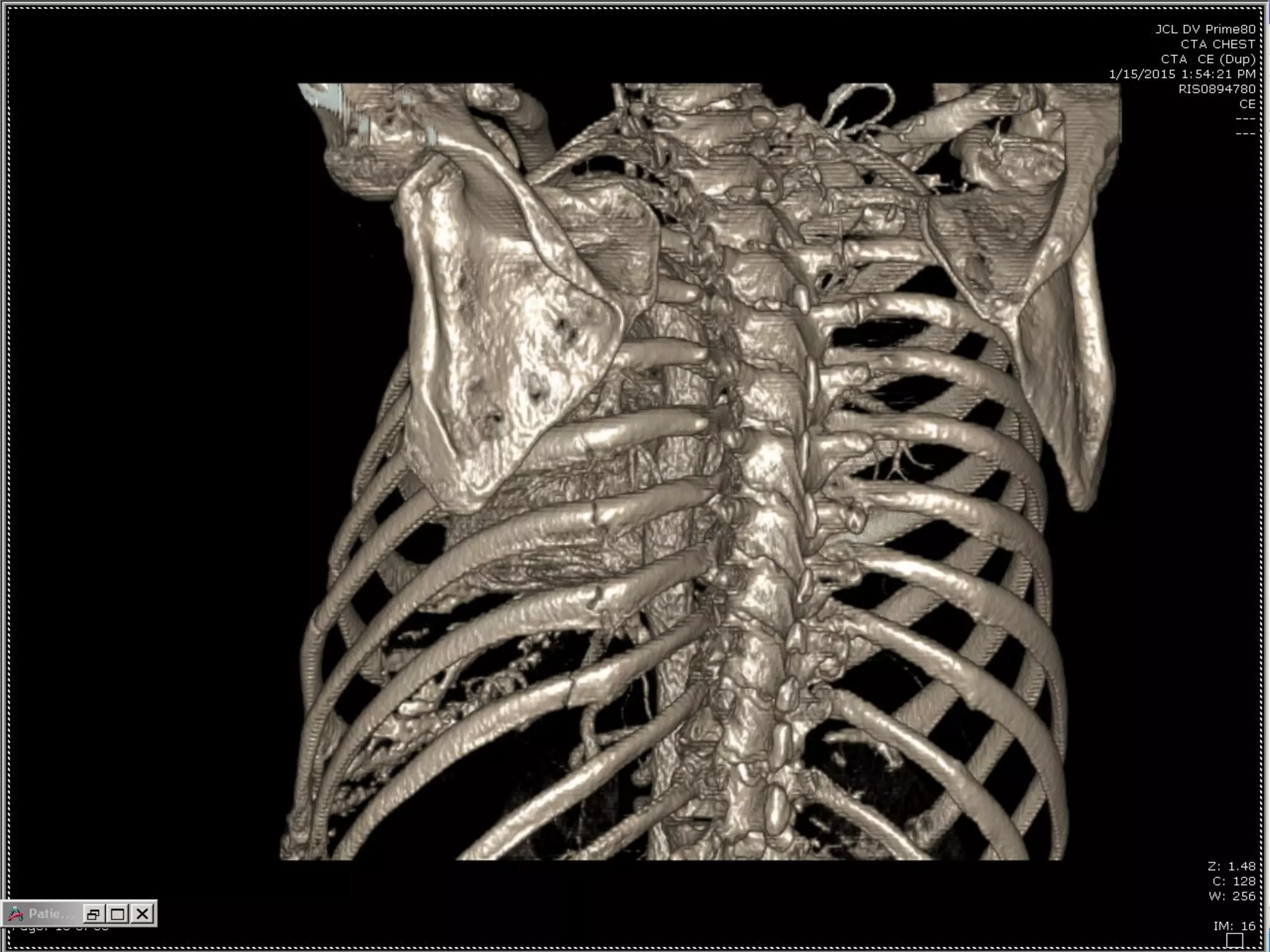 Rib Fractures in the Elderly (Dr. Francis Ali-Osman) | PDF