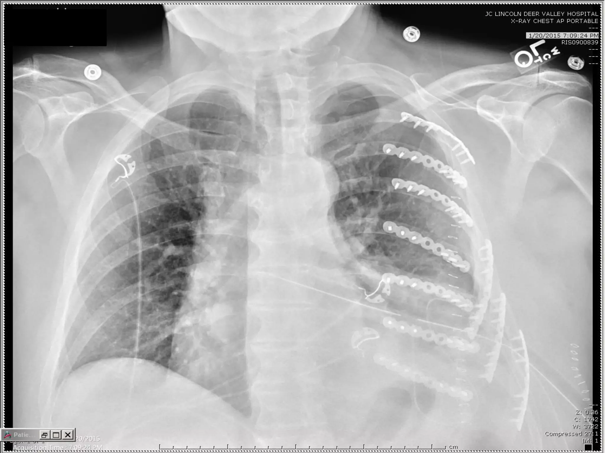 Rib Fractures in the Elderly (Dr. Francis Ali-Osman) | PDF
