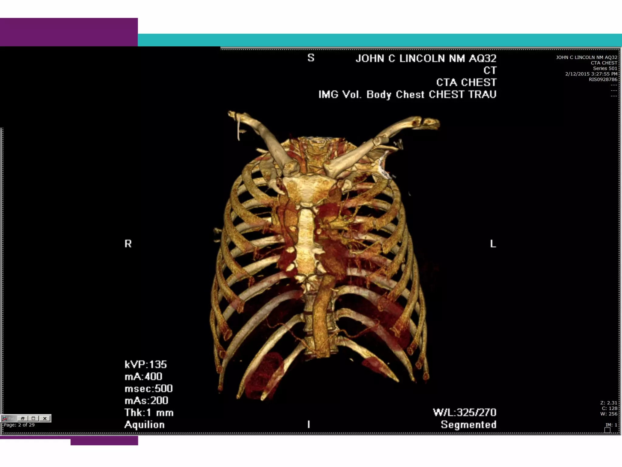 Rib Fractures in the Elderly (Dr. Francis Ali-Osman) | PDF