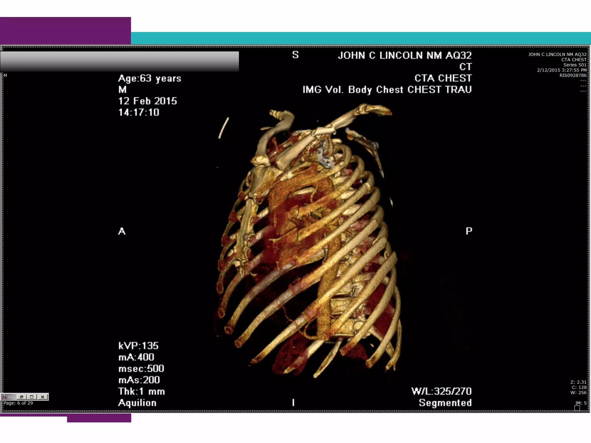 Rib Fractures in the Elderly (Dr. Francis Ali-Osman) | PDF