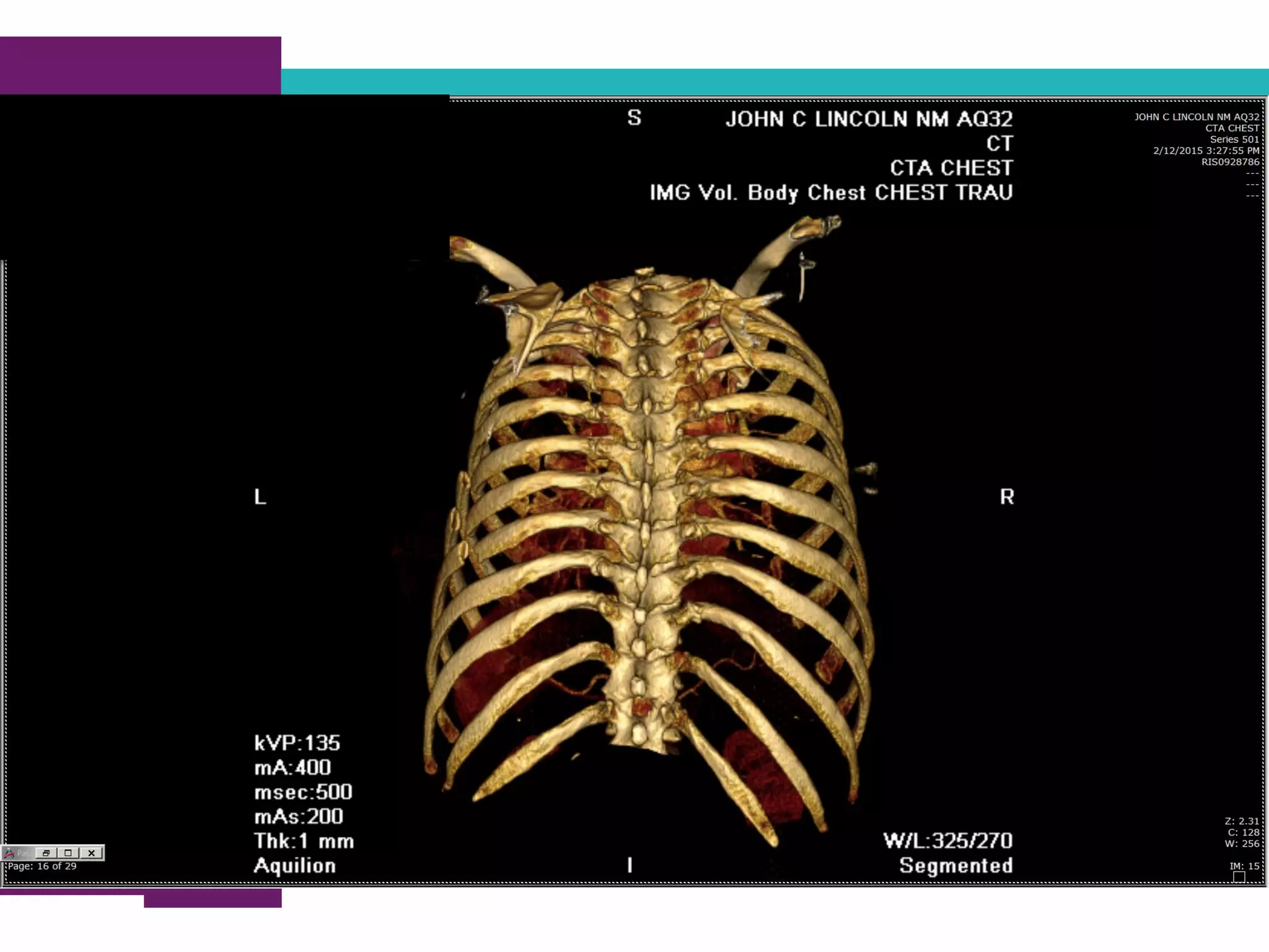 Rib Fractures in the Elderly (Dr. Francis Ali-Osman) | PDF