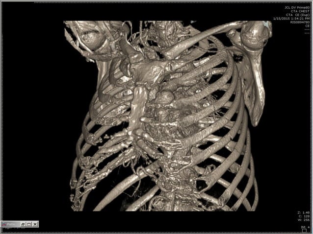 Rib Fractures in the Elderly (Dr. Francis Ali-Osman) | PPT