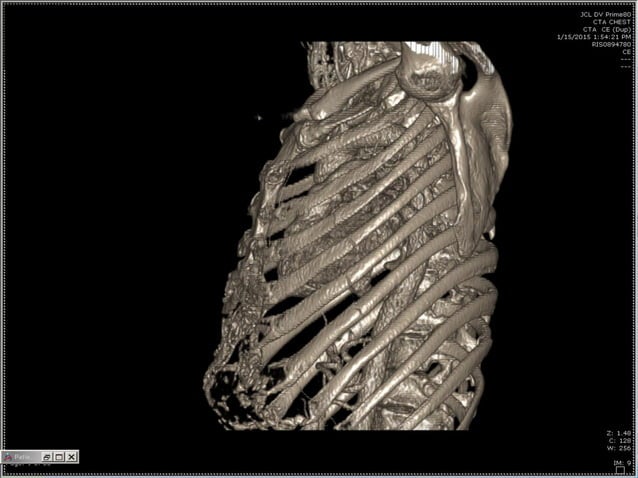 Rib Fractures in the Elderly (Dr. Francis Ali-Osman) | PPT