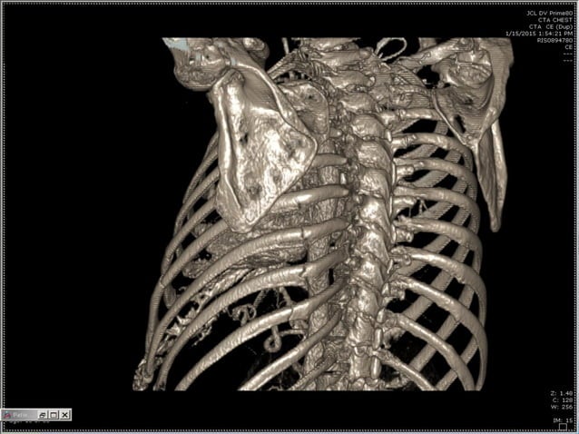 Rib Fractures in the Elderly (Dr. Francis Ali-Osman) | PPT