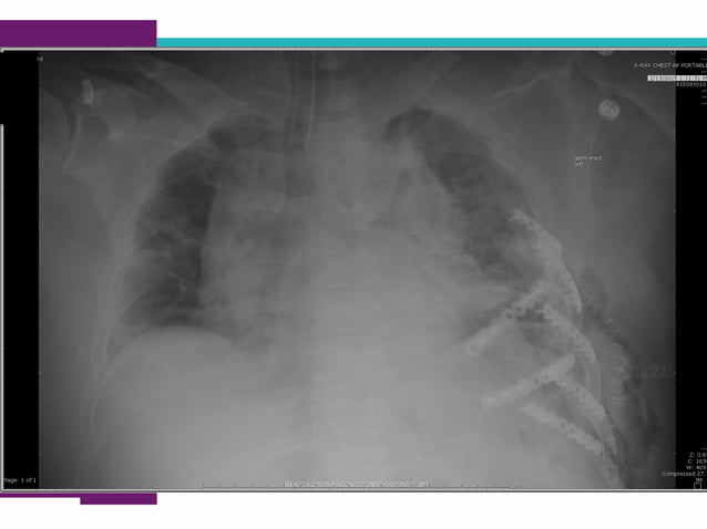 Rib Fractures in the Elderly (Dr. Francis Ali-Osman) | PPT