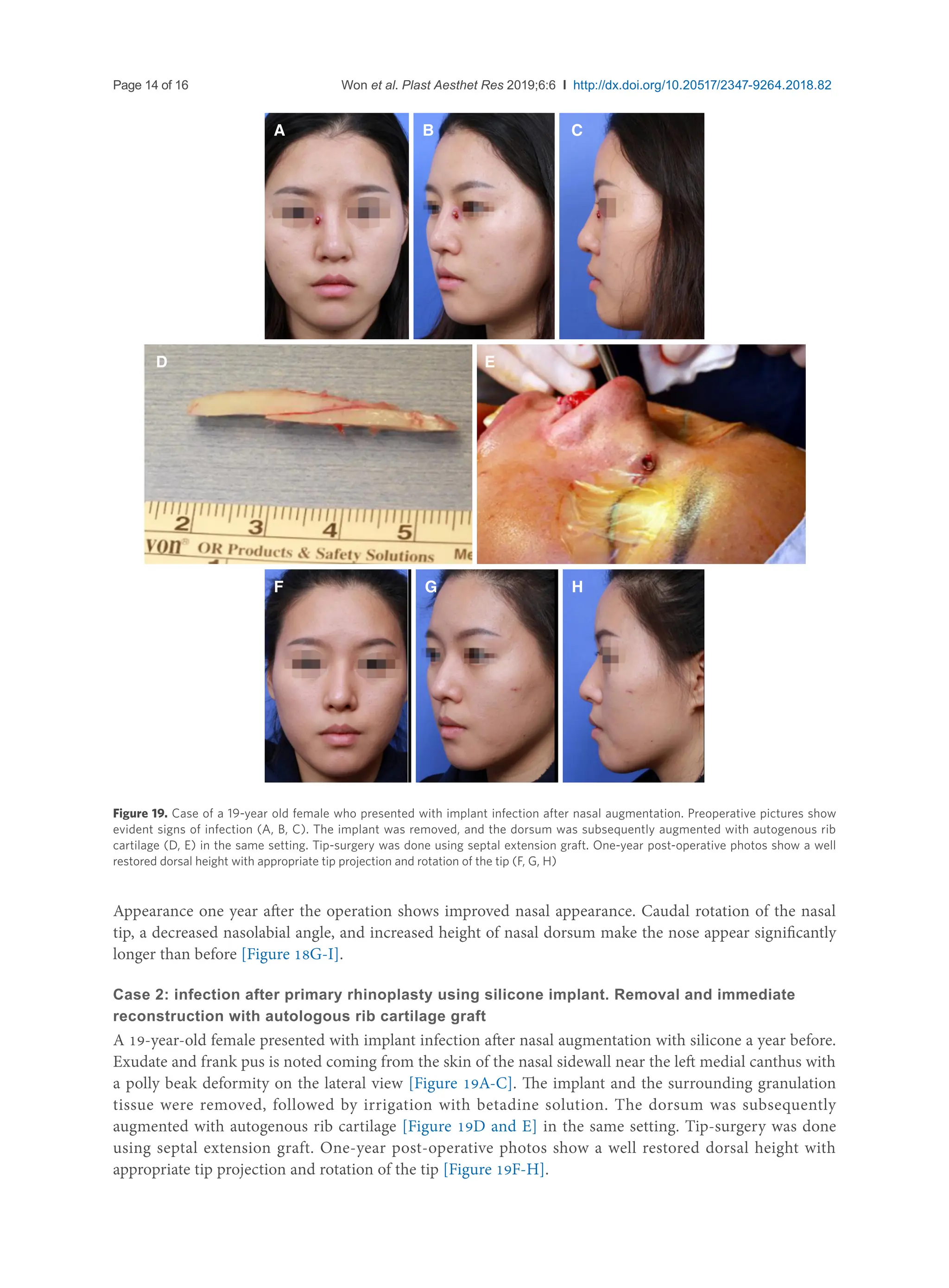 rib graft for rhinoplasty. revision rhino using autologous rib ...