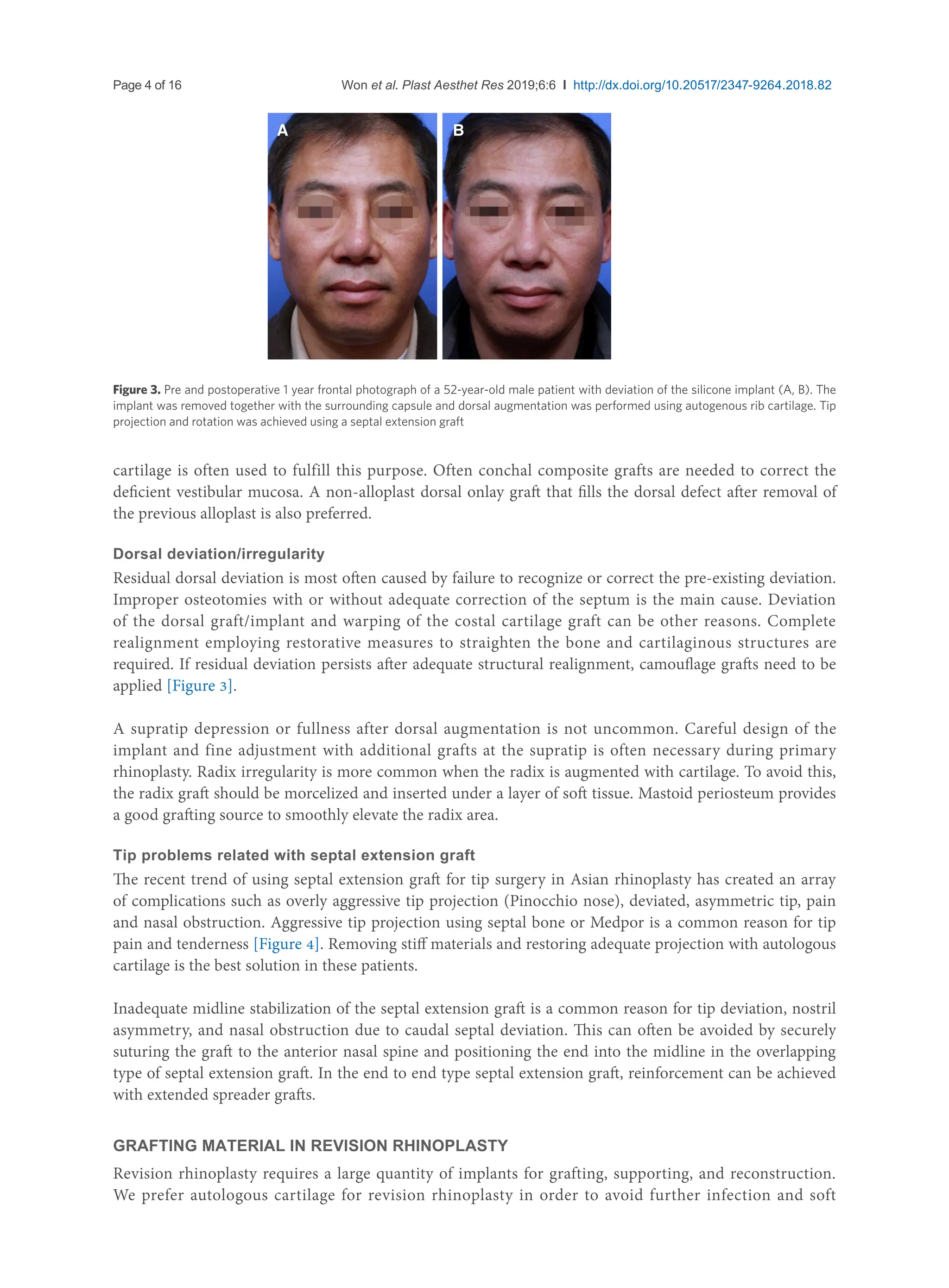 rib graft for rhinoplasty. revision rhino using autologous rib ...