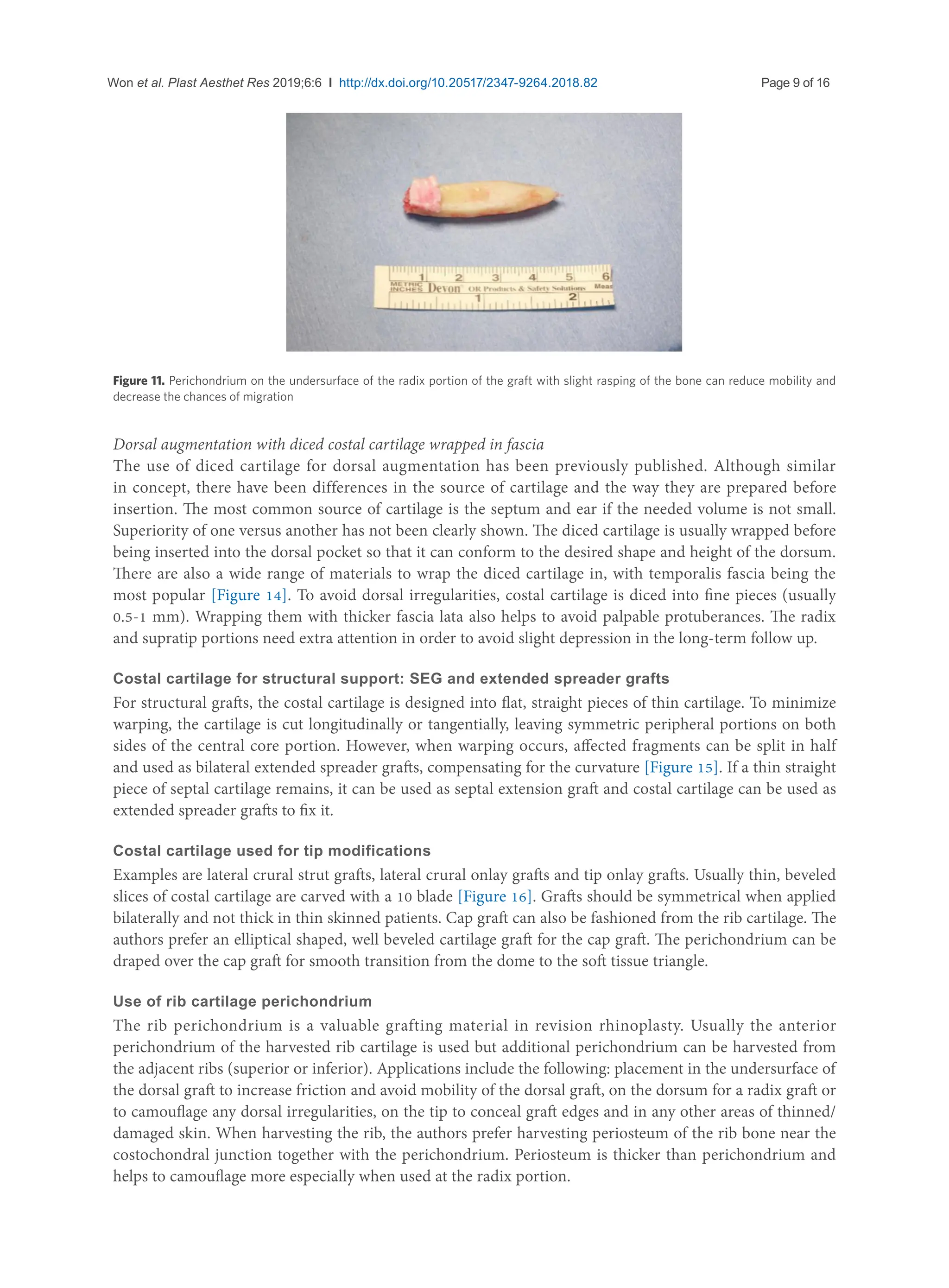 rib graft for rhinoplasty. revision rhino using autologous rib ...