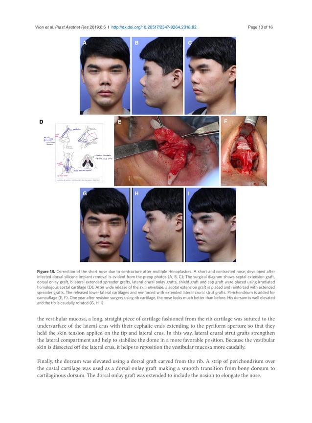 rib graft for rhinoplasty. revision rhino using autologous rib ...