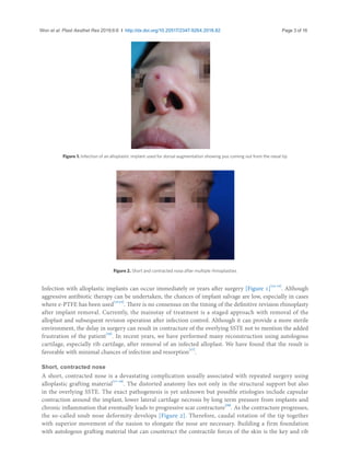 rib graft for rhinoplasty. revision rhino using autologous rib ...