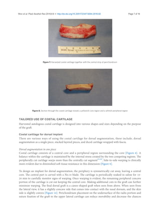 rib graft for rhinoplasty. revision rhino using autologous rib ...