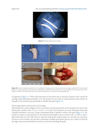 rib graft for rhinoplasty. revision rhino using autologous rib ...