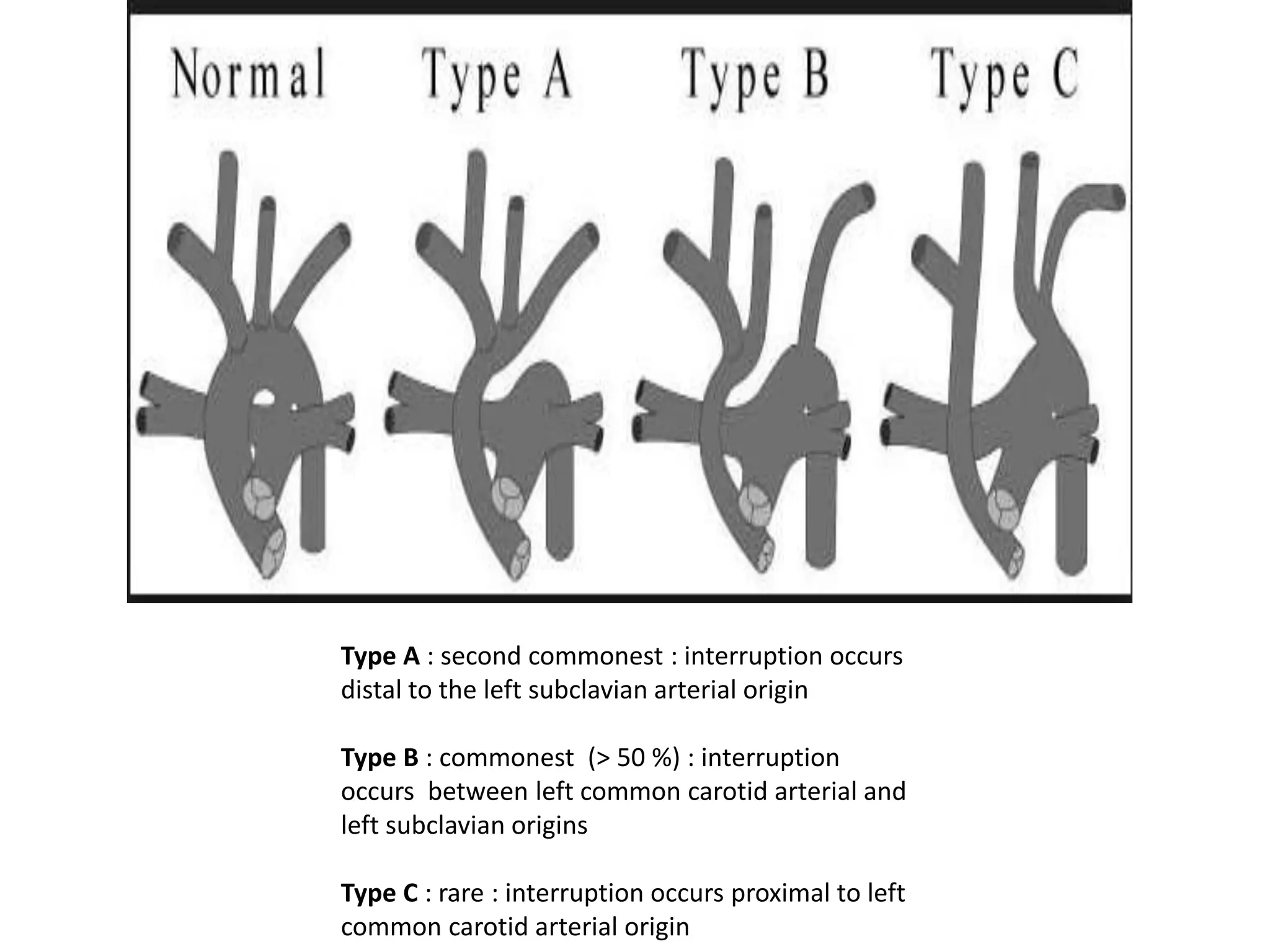 Rib notching | PPTX