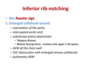 Rib notching | PPTX
