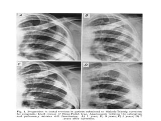 Rib notching | PPTX