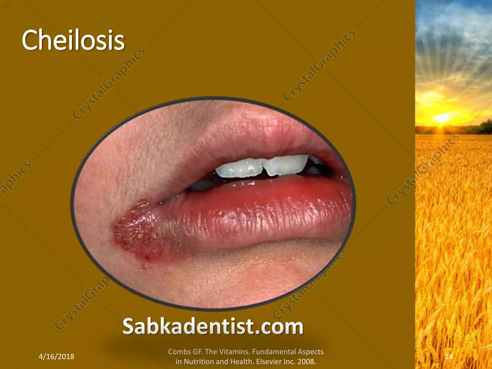 Riboflavin deficiency and toxicity | PPSX