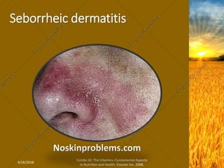 Riboflavin deficiency and toxicity | PPSX