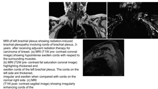 RADIATION INDUCED BRACHIAL PLEXUS NEUROPATHY | PPT