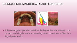 MANDIBULAR MAJOR CONNECTORS | PPTX