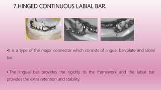 MANDIBULAR MAJOR CONNECTORS | PPTX