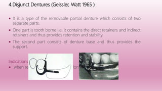 MANDIBULAR MAJOR CONNECTORS | PPTX