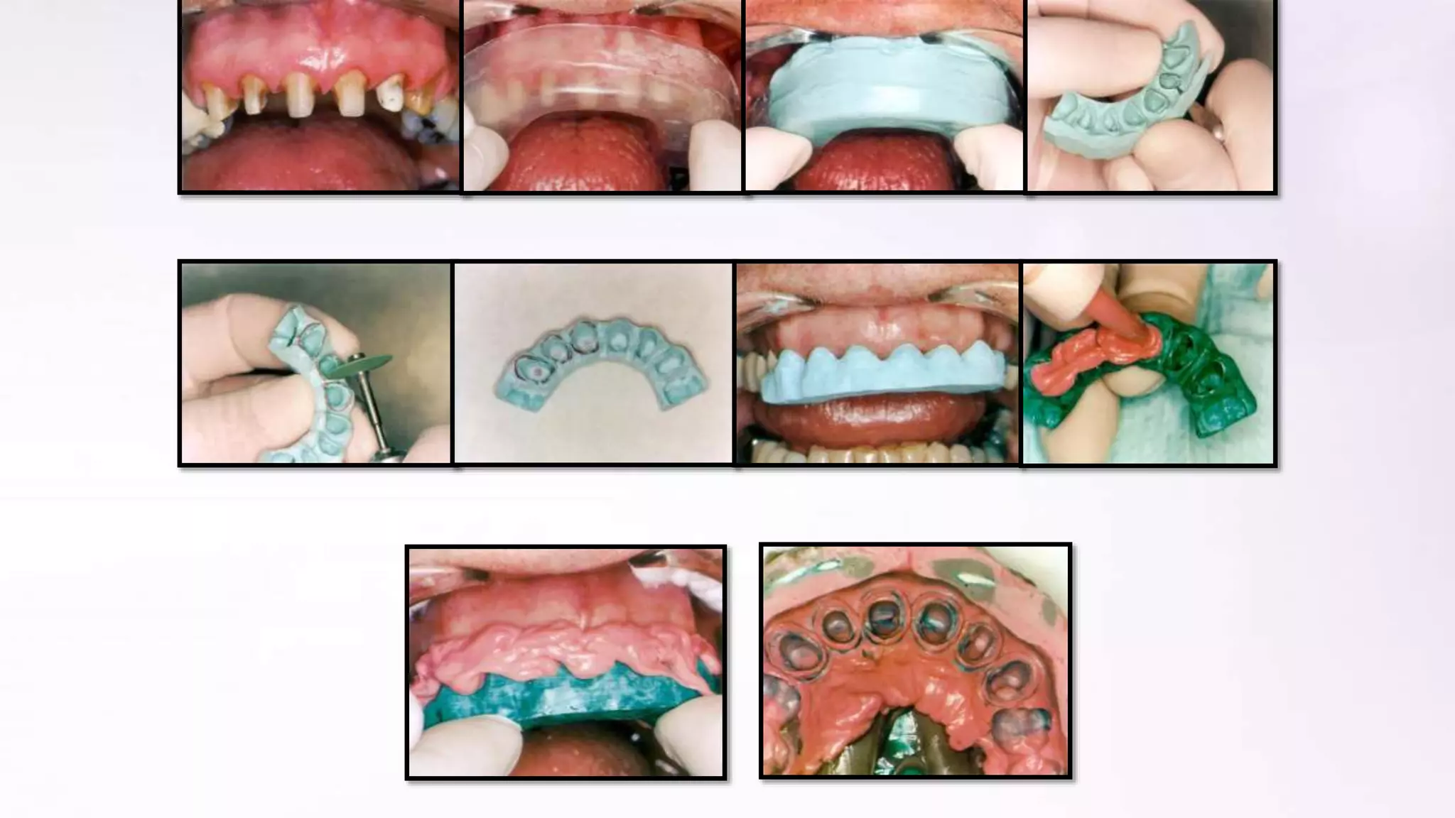 Impression Techniques in Fixed partial denture | PPTX