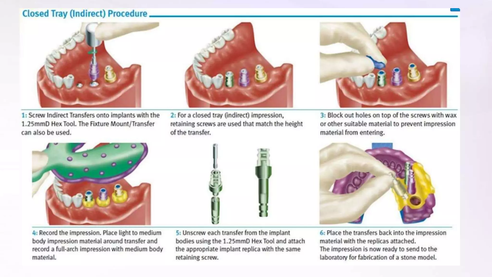 Impression Techniques in Fixed partial denture | PPTX