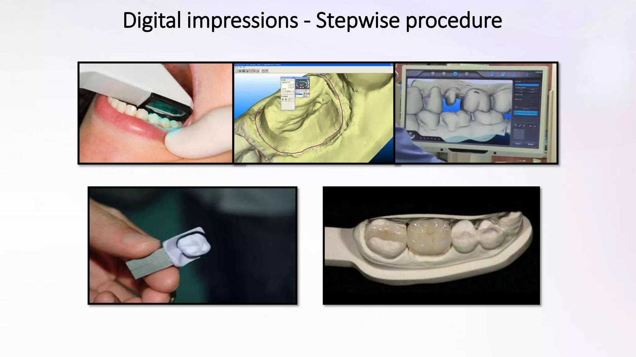 Impression Techniques in Fixed partial denture | PPTX
